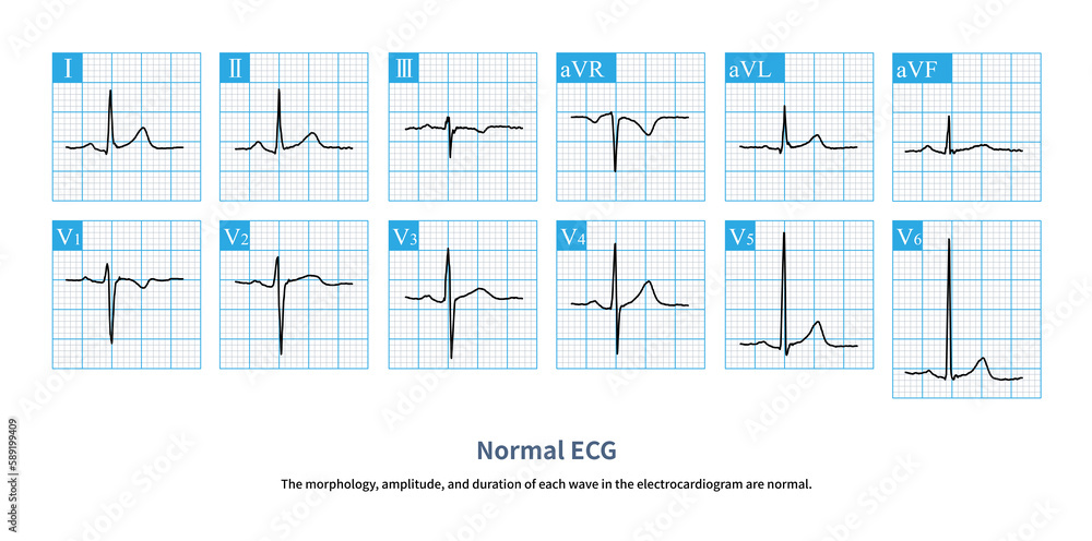 The normal rhythm is sinus rhythm.The morphology, amplitude, and ...