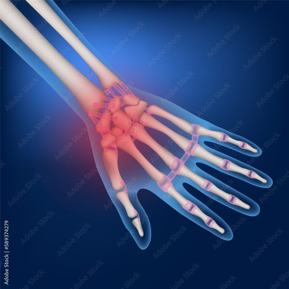 Bones of a human hand on a blue background. Inflammation of the joints ...