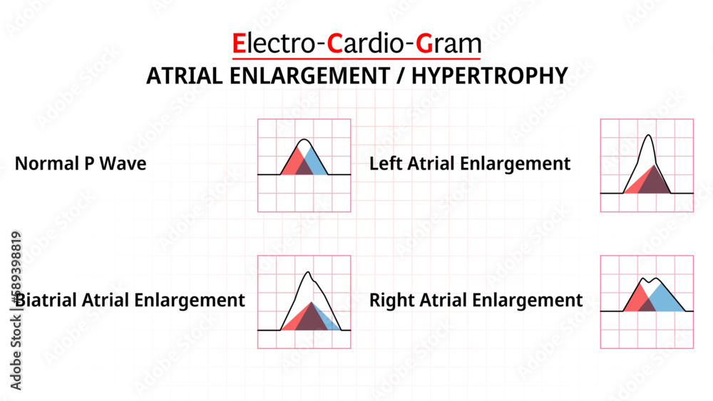 Vecteur Stock The Difference Abnormal P Wave - ECG Biatrial Enlargement, Right Atrial Erlagement ...
