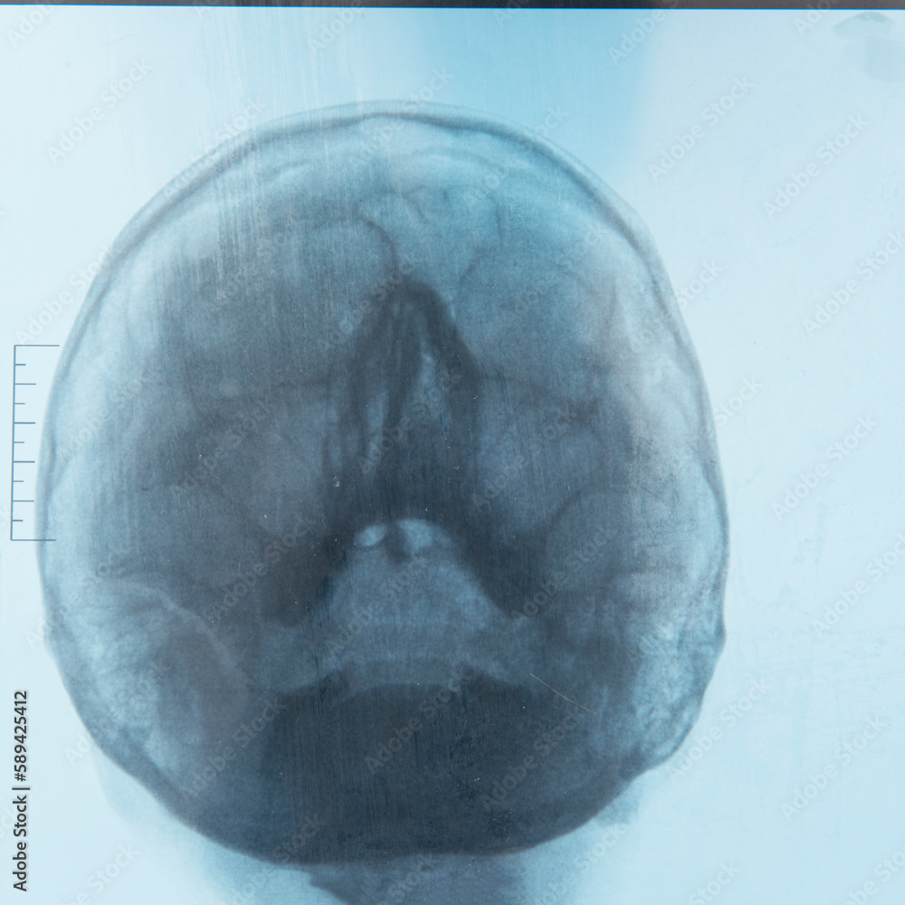 Human brain on MRI scans Frontal Stock Photo | Adobe Stock