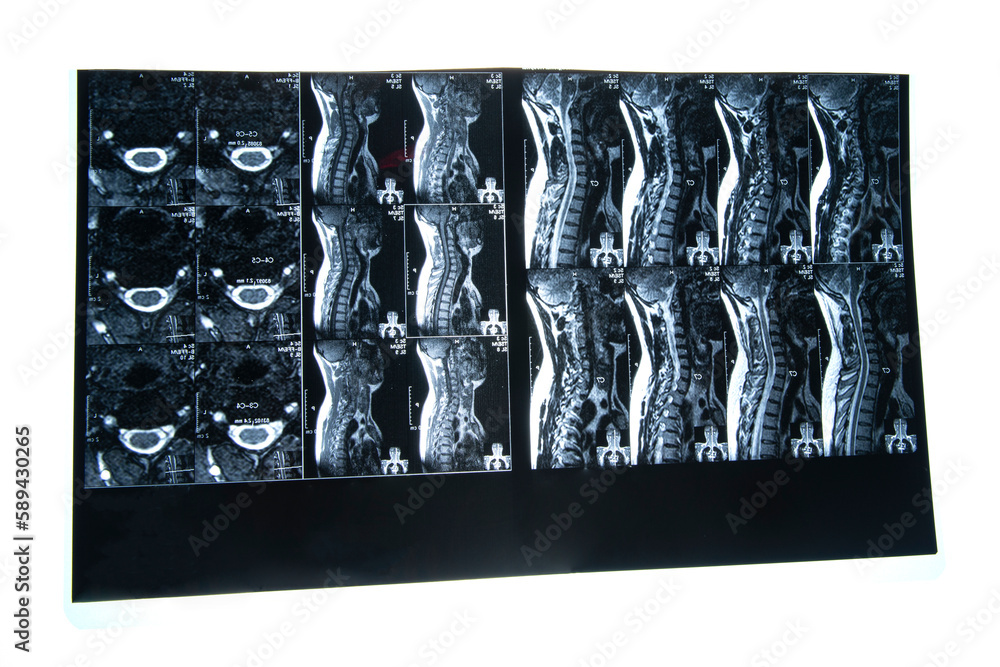 MRI xray film scan of sacro-lumbar spines of a patient with chronic ...