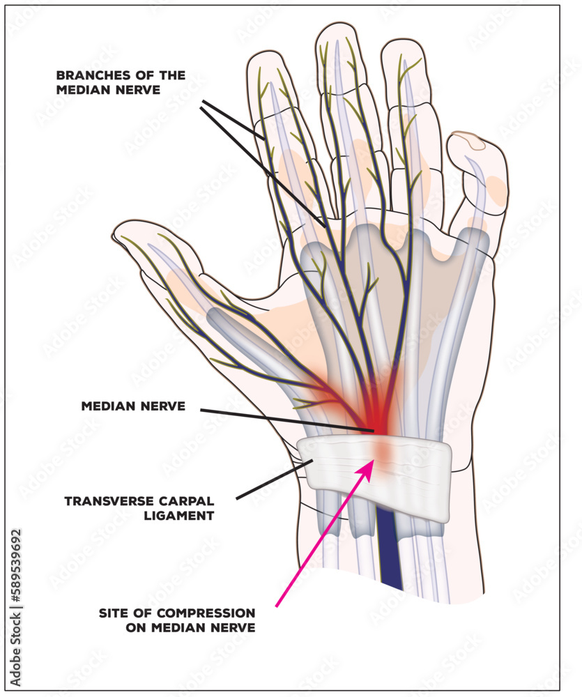 Site of compression of the median nerve in carpal tunnel syndrome Stock ...