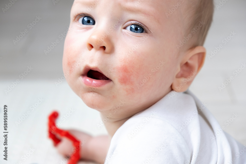Baby face with atopic dermatitis on cheeks. Eczema. Allergy. Dry skin ...