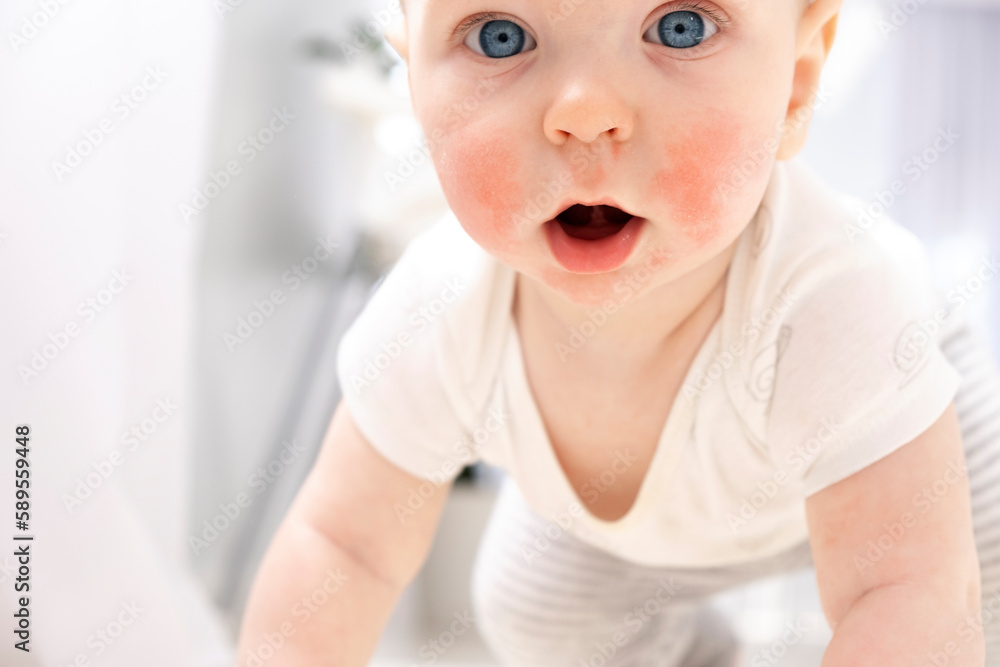 Baby face with allergic rash on cheeks. Atopic dermatitis. Eczema. Dry ...