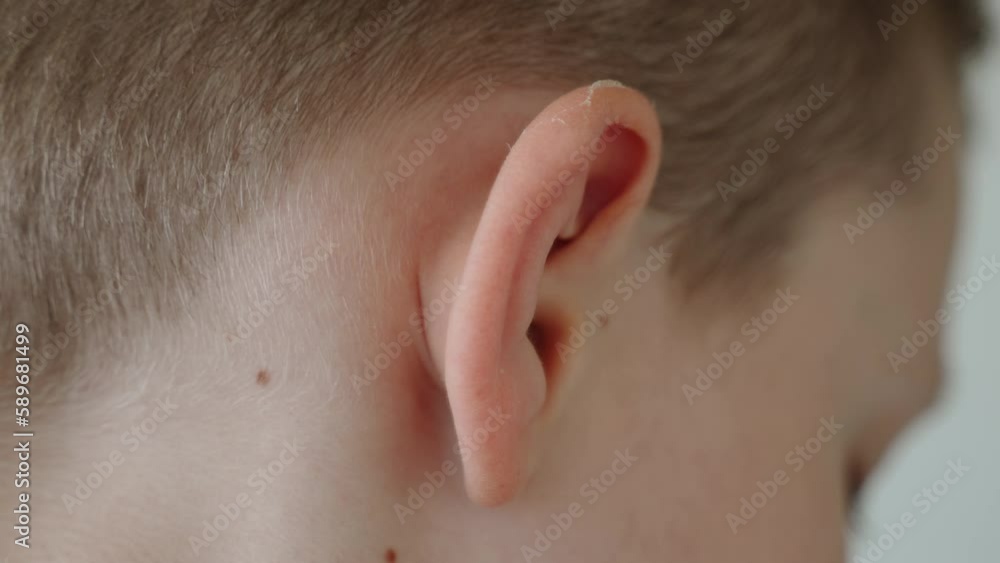 Vidéo Stock Peeling and dry skin on the edge of boy ear after sunburn ...