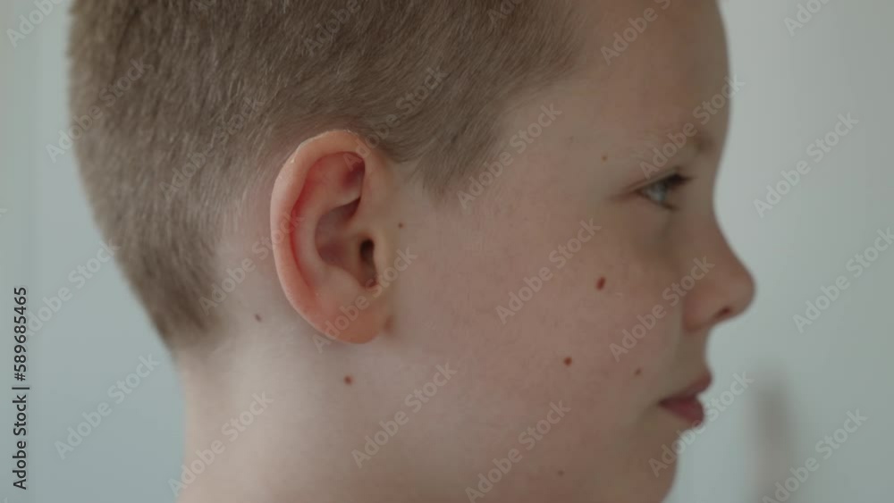 Peeling and desquamation of thin layers of skin on child ear, close-up ...