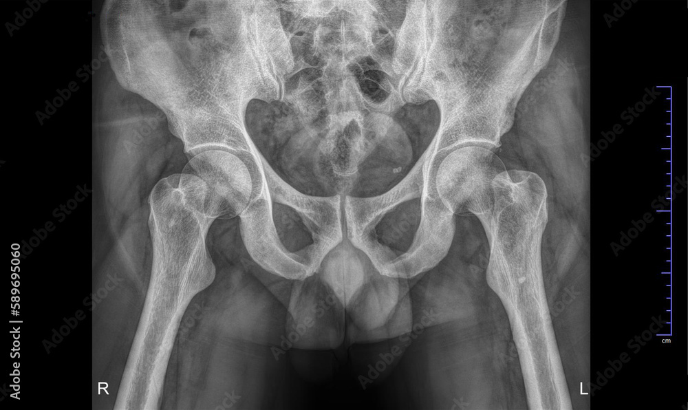 X-ray radiograph of the pelvis and hips of a man Stock Photo | Adobe Stock