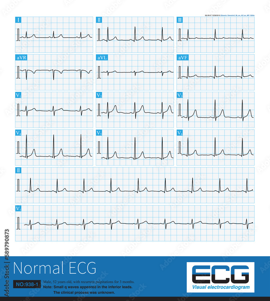 Sometimes, in middle-aged people, small q waves appear in inferior ...