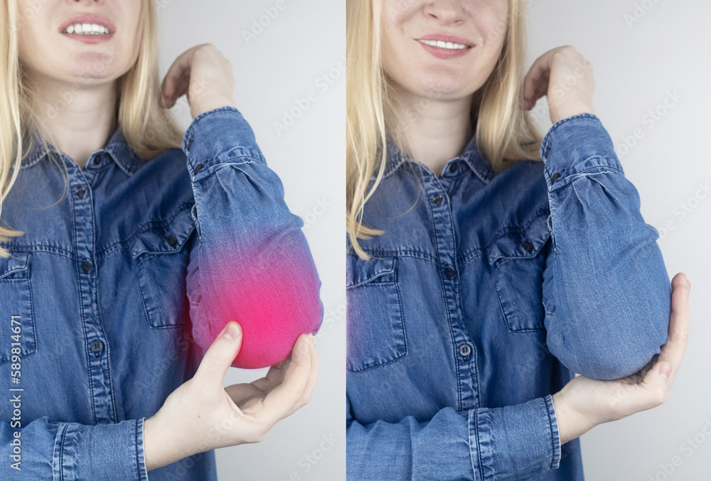Fotka „Before and after. Elbow pain. Girl shows consequences of tennis ...