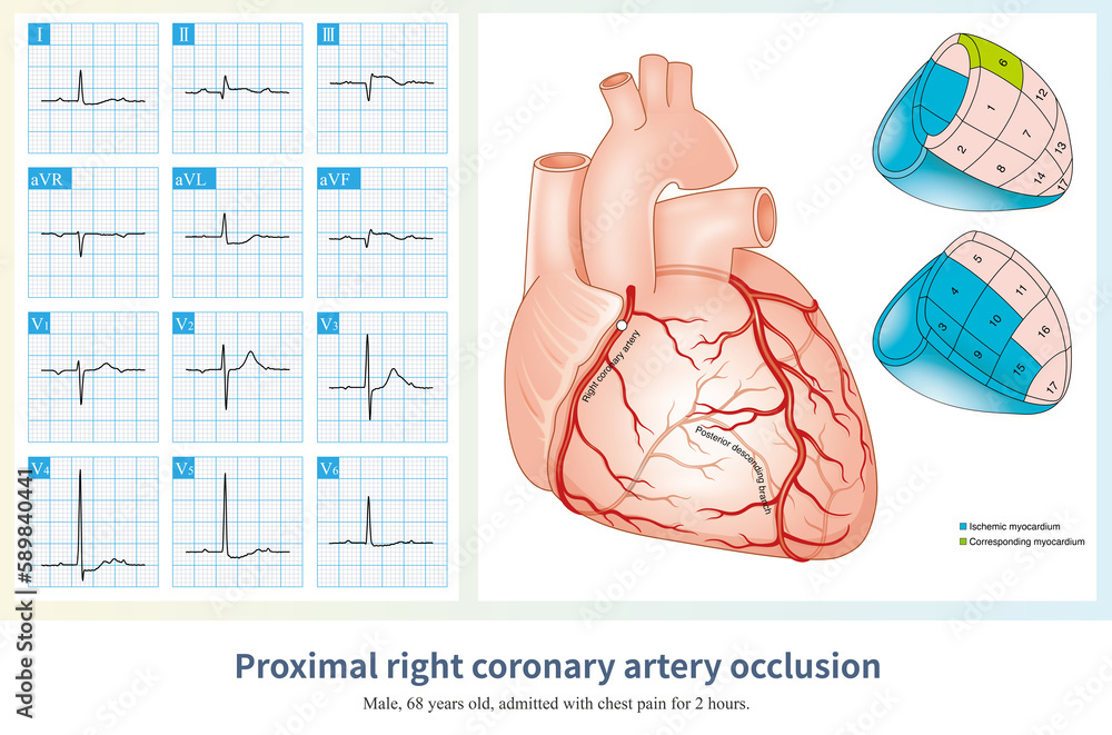When acute inferior myocardial infarction is caused by right coronary artery occlusion, the ...