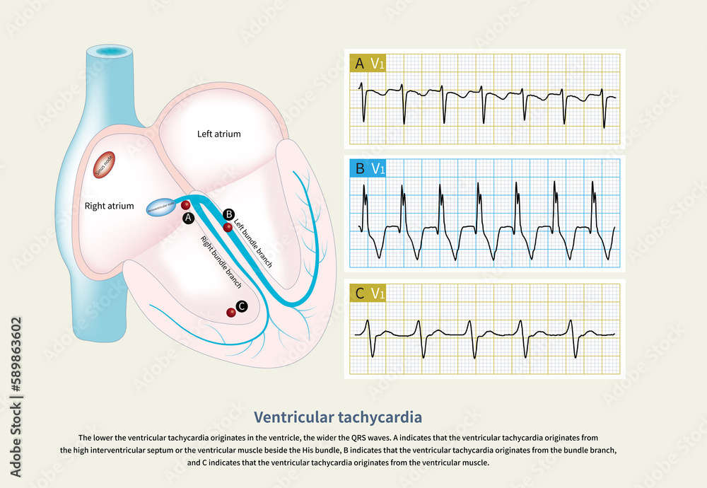 It is worth noting that ventricular tachycardia originating from ...