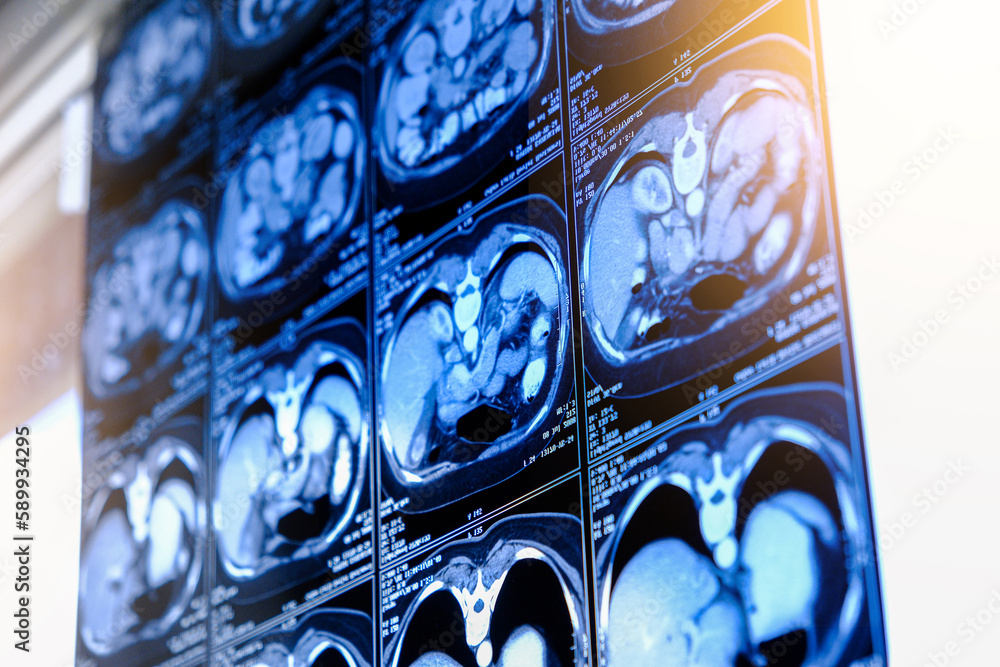 Poster Computed tomography (CT scan) of chest with abdomen – Wall Art ...