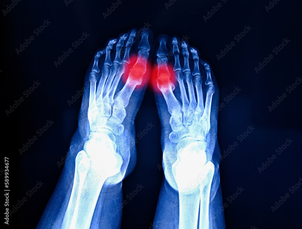 Film x-ray foot radiograph show pain area with red, isolated on dark ...