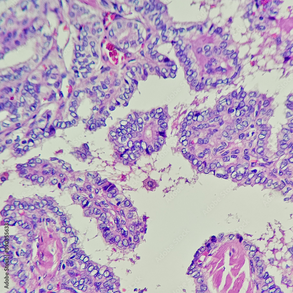 Camera photo of a papillary thyroid carcinoma, showing characteristic ...