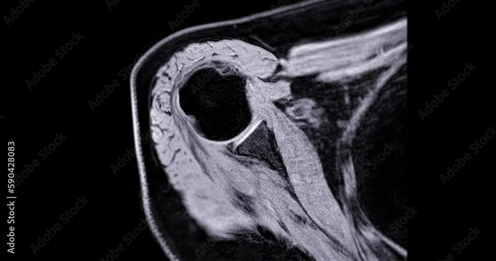 Magnetic Resonance Imaging or MRI of Shoulder Joint for diagnostic ...