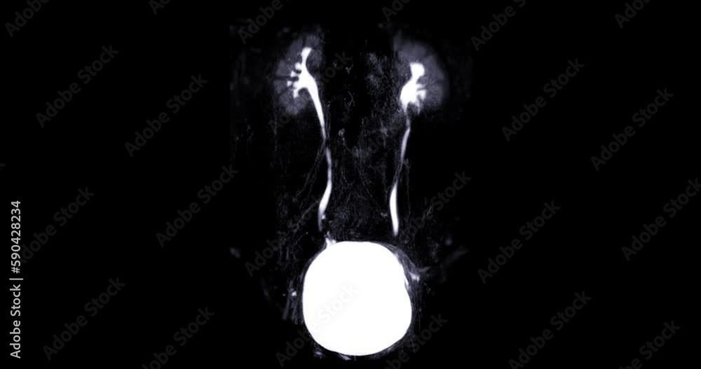 Magnetic resonance urography (MR urography) is a MRI study that ...
