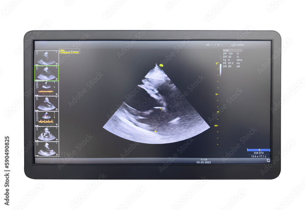 Ultrasound image on the monitor close-up. Ultrasound scan examination ...