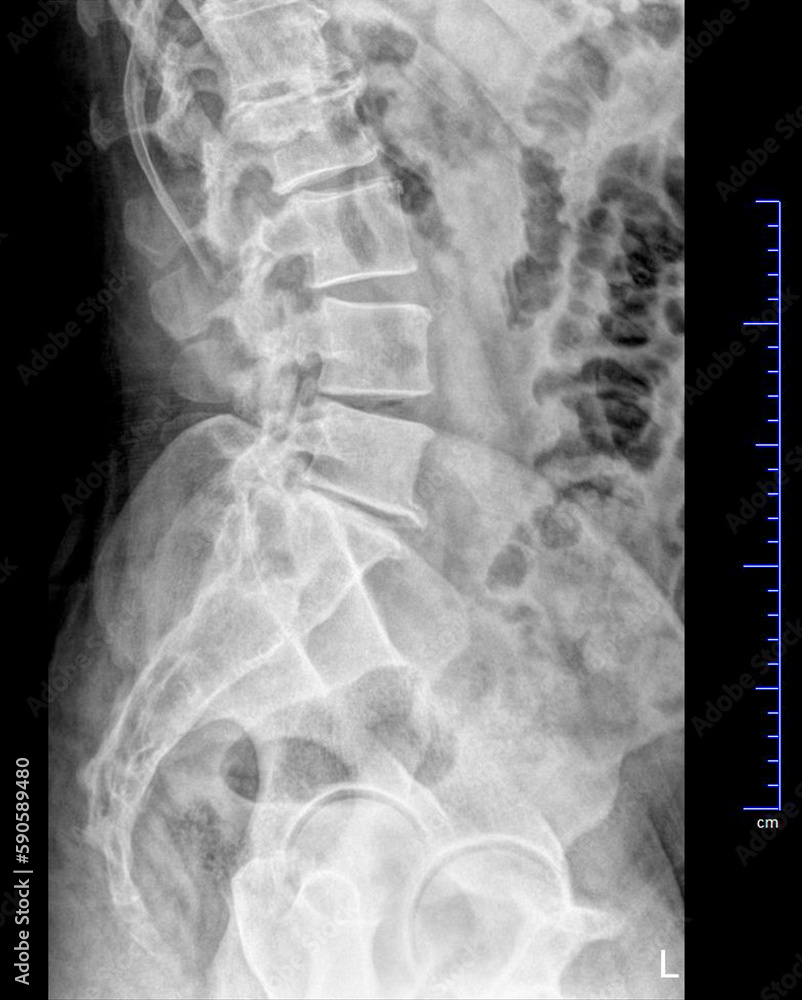 X-ray radiograph of the pelvis and spinal column , side view Stock ...