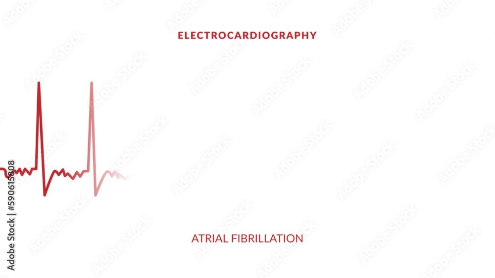 Animated EKG Display. Animated Atrial Fibrillation Stock Video | Adobe ...