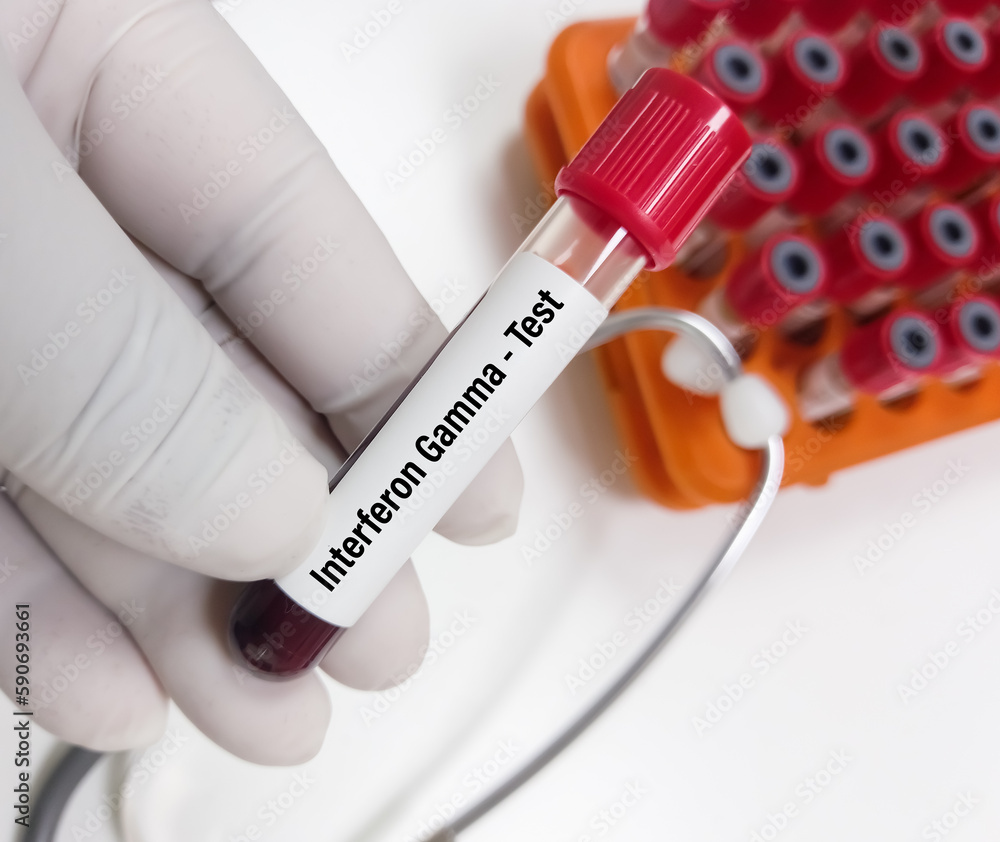 Scientist holds blood sample for Interferon gamma test to diagnosis of ...
