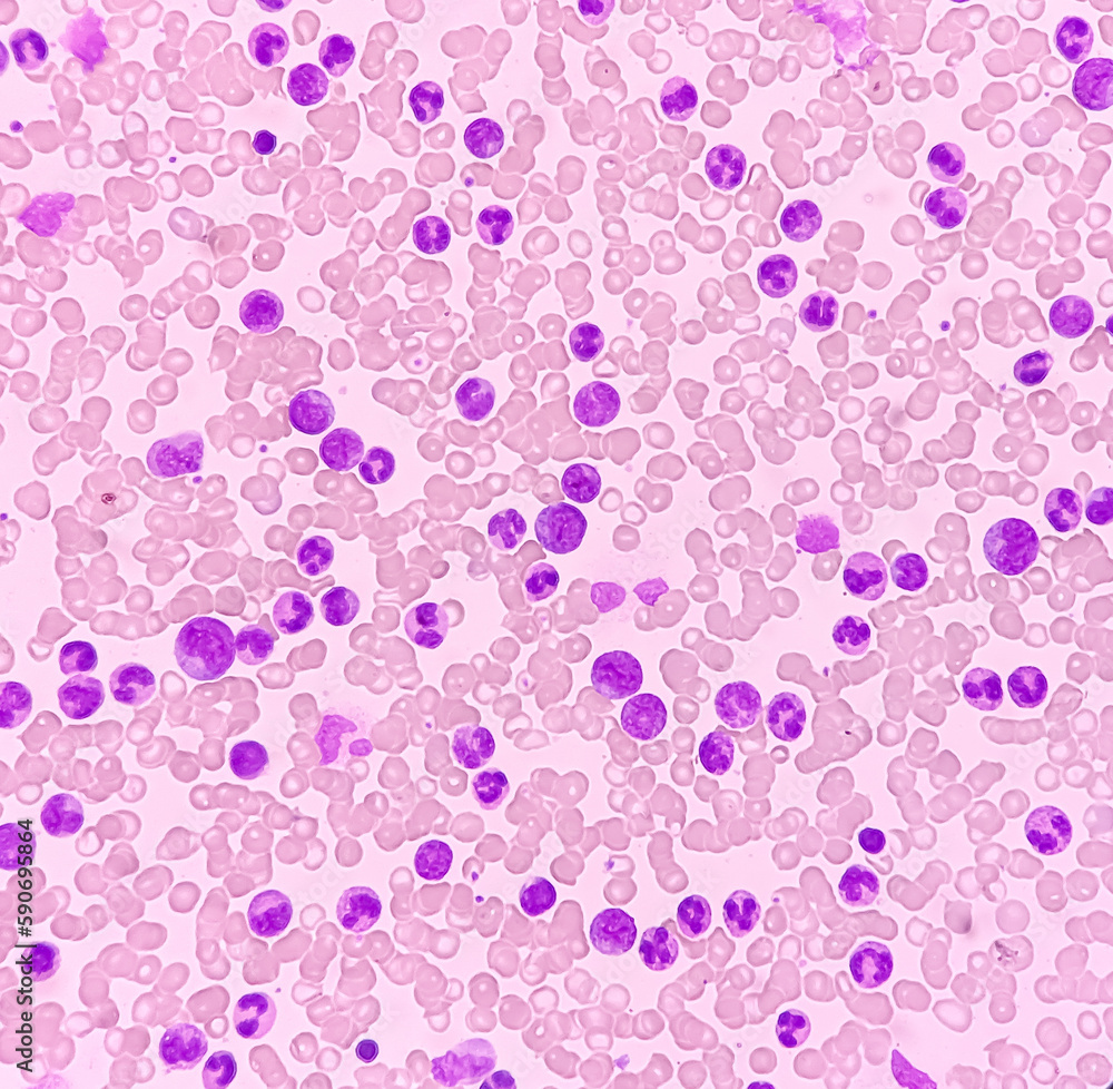 Blood cancer. Chronic myeloid leukemia(CML) with Thrombocytopenia ...