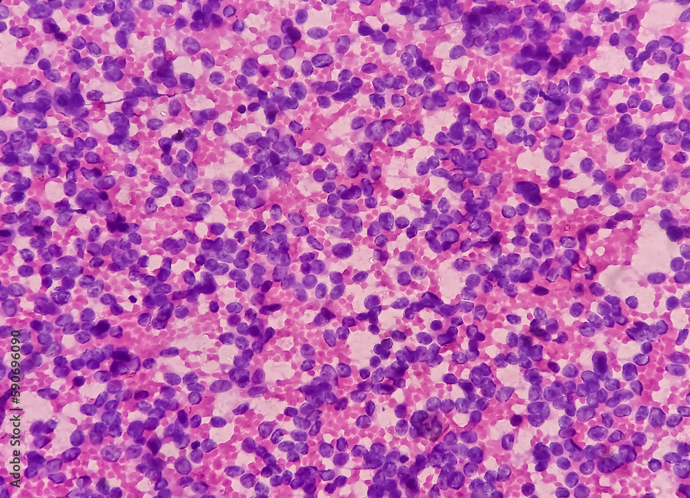 USG guided FNA cytology from liver SOL. Non-Hodgkin lymphoma. Smear ...