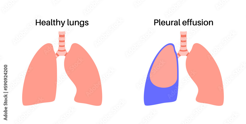 Pleural effusion poster Stock Vector | Adobe Stock
