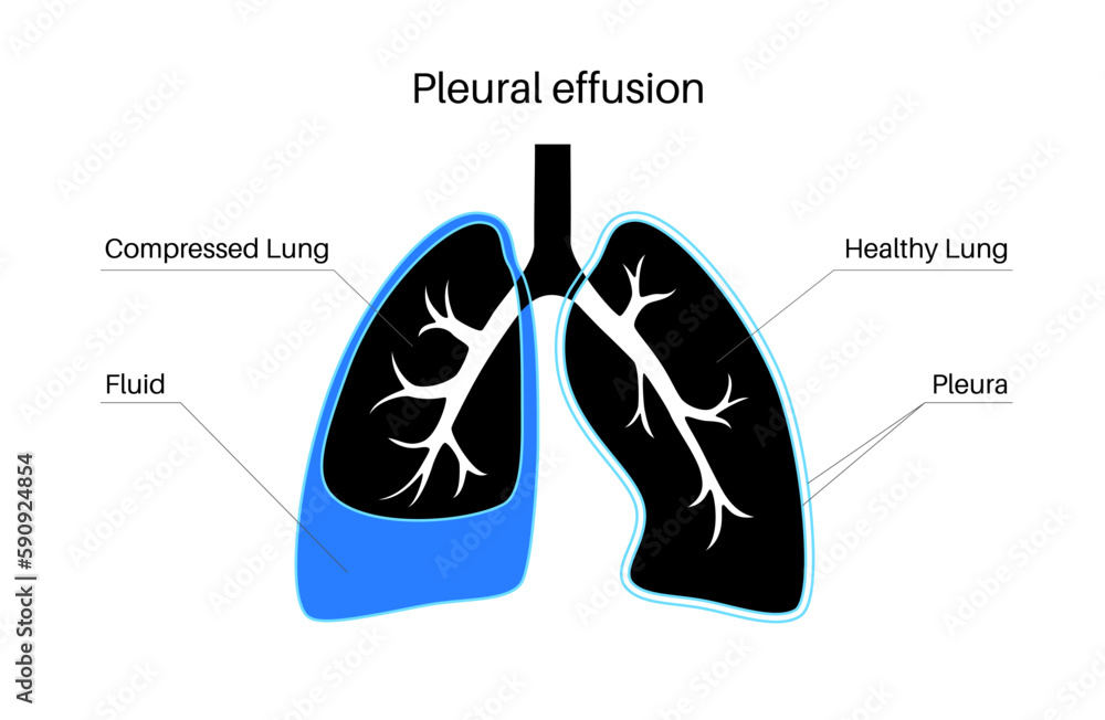 Pleural effusion poster Stock Vector | Adobe Stock
