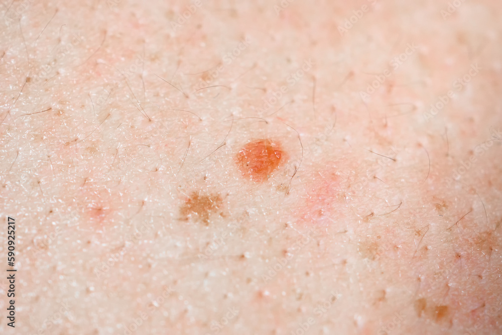 Mole birthmark nevus macro photo on human skin. crochordon or soft ...
