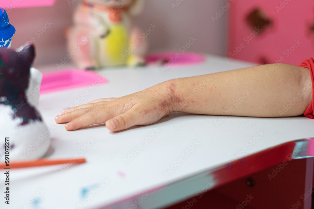 (selective focus) Red rash on skin from allergic reactions. baby rash ...