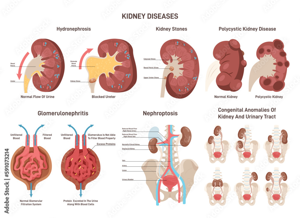 Diseased Kidney
