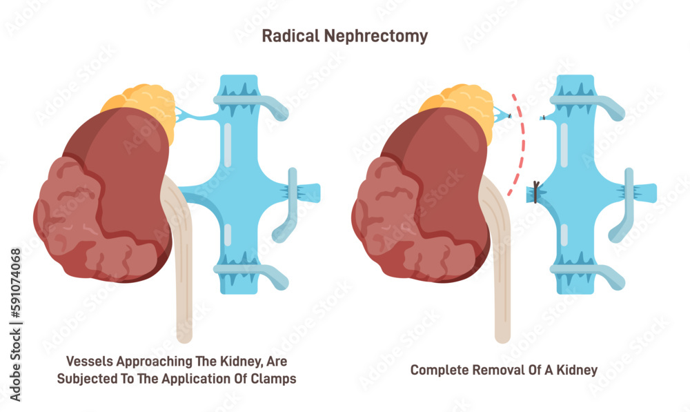Nephrectomy, surgical removal of a kidney. Diseased swelling kidney ...