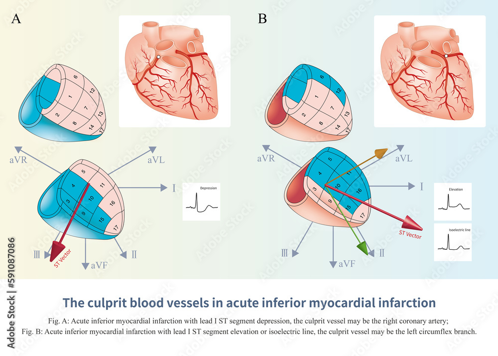 If there is ST segment depression in lead I of the electrocardiogram ...
