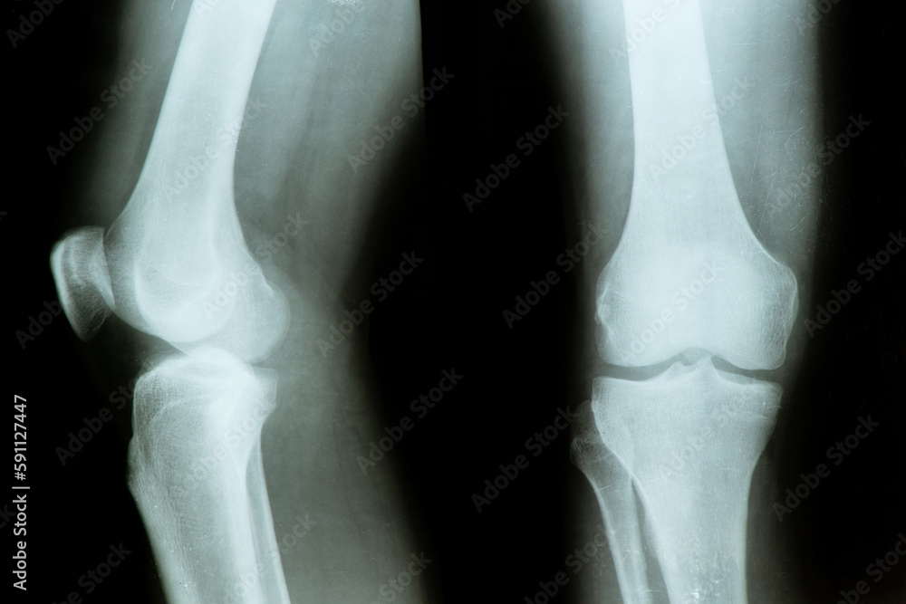 X-ray of a patient with a torn meniscus of the knee joint in a man and ...