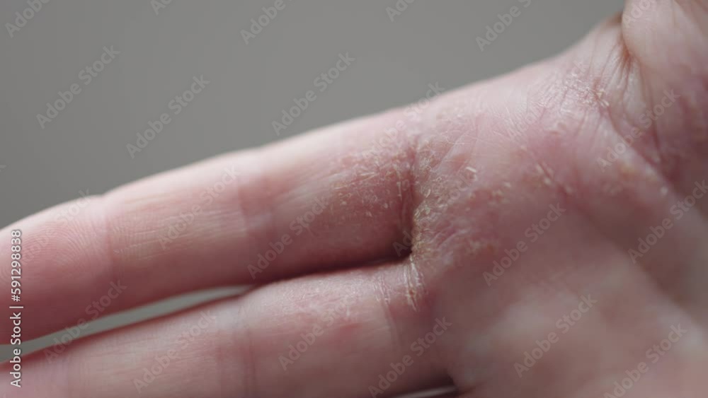 close-up dry cracked skin palm hand inflammation psoriasis dermatitis ...