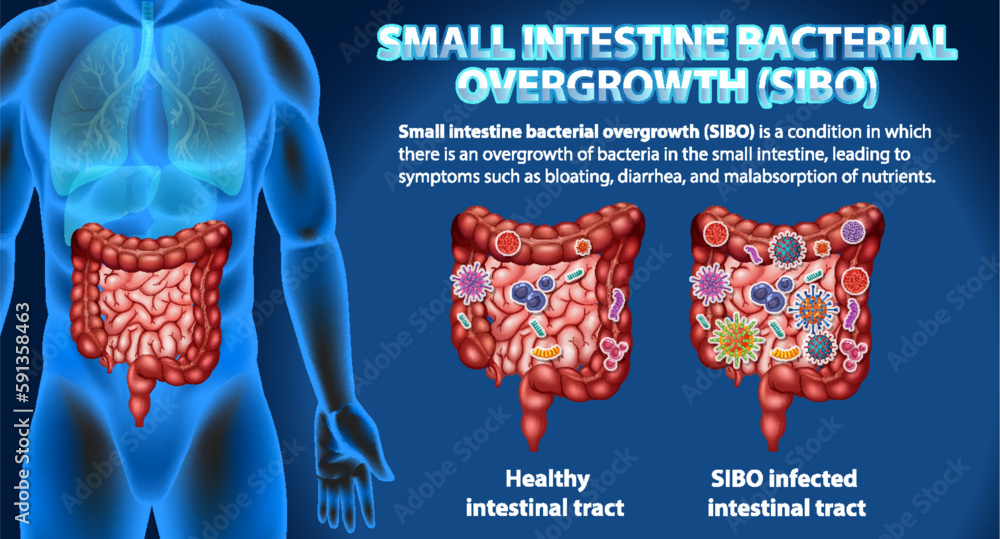 Small Intestine Bacterial Overgrowth (SIBO) Stock Vector | Adobe Stock