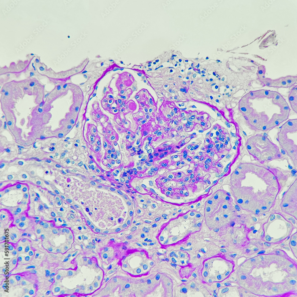 Camera photo of lupus nephritis, showing endocapillary hypercellularity ...