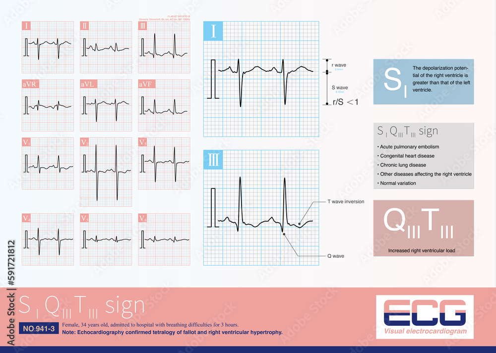 SⅠQⅢTⅢ sign is an electrocardiogram change of right heart disease ...