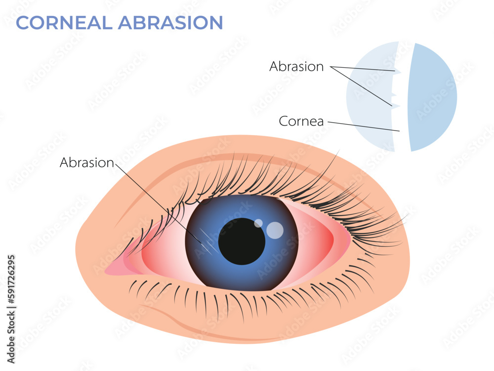 Corneal abrasion illustration. Eye redness symptom. pink red surfer's ...