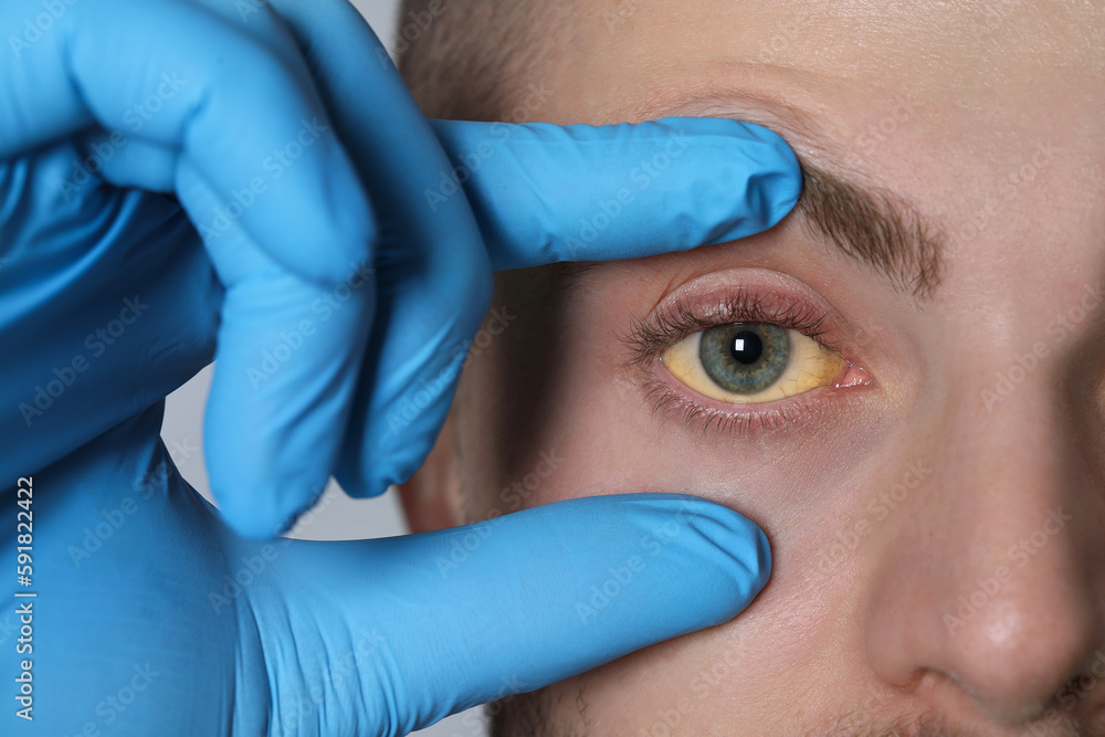 Doctor checking yellow eyes of patient on light grey background ...