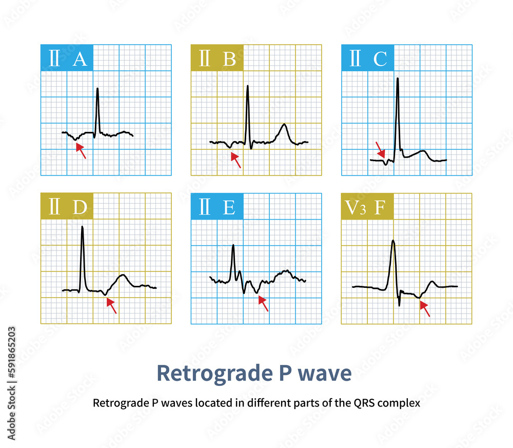 On the electrocardiogram, the retrograde P wave can be located before ...
