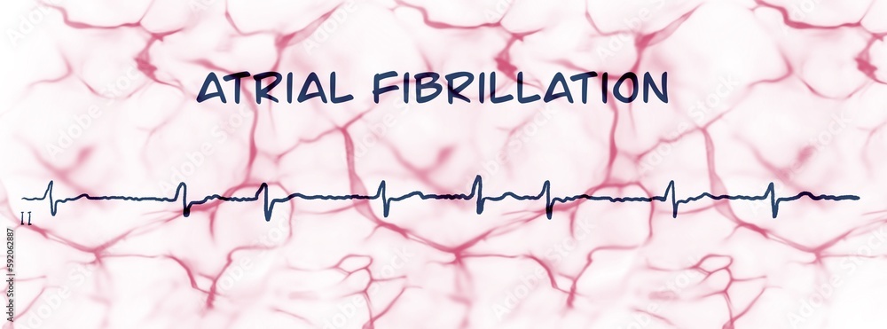 ECG example of atrial fibrillation Stock Illustration | Adobe Stock