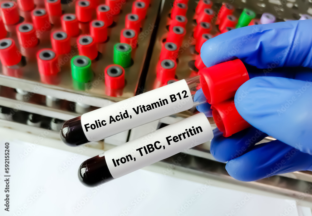 Scientist holding blood samples for Iron, TIBC, Ferritin and Folic acid ...