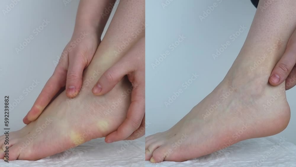 Before and after. Sole of the foot pain, tendon sprains, inflammation ...