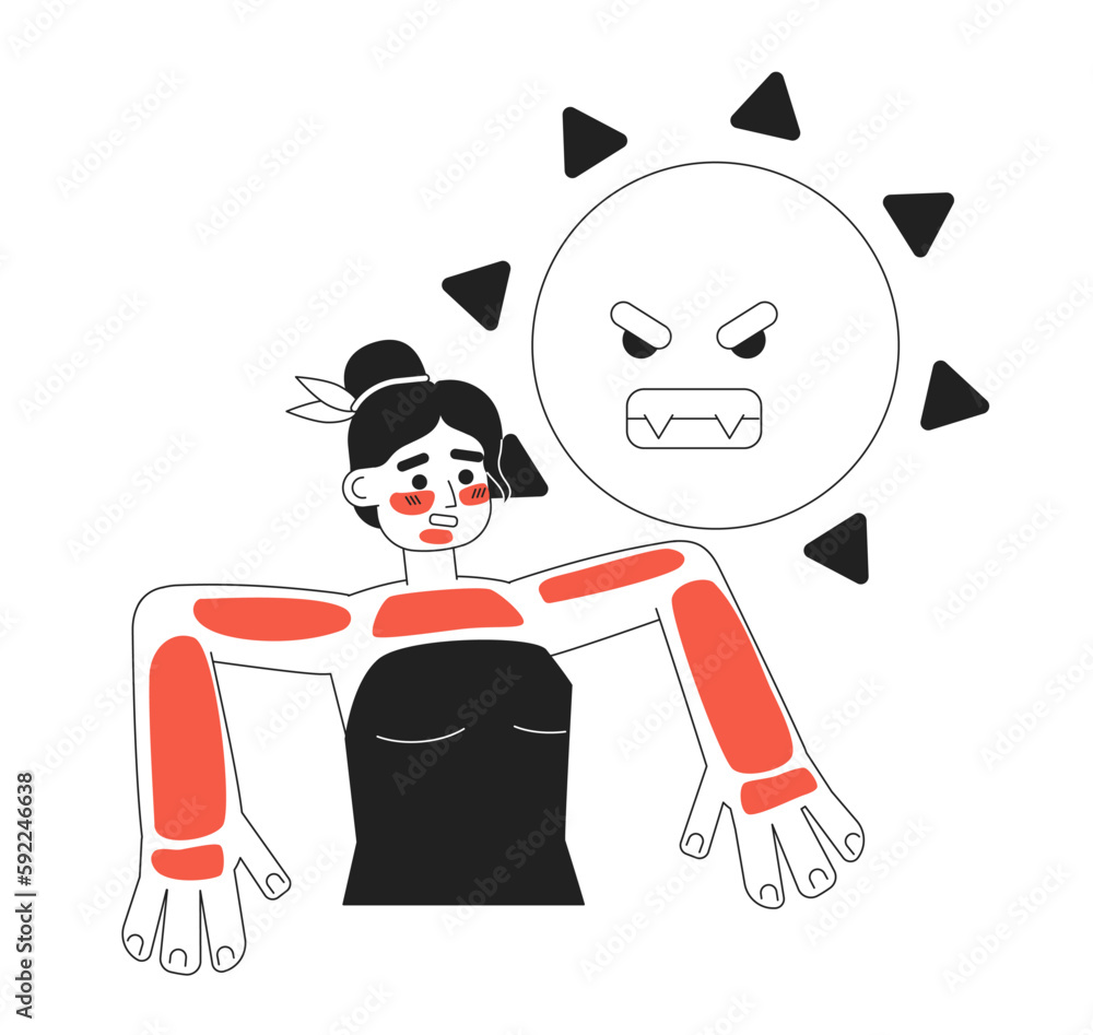 Sunburn redness monochrome concept vector spot illustration. Editable ...