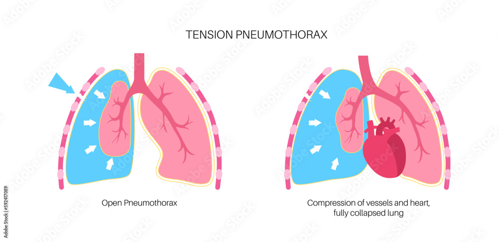 Tension Pneumothorax Poster Stock Vector Adobe Stock 7558