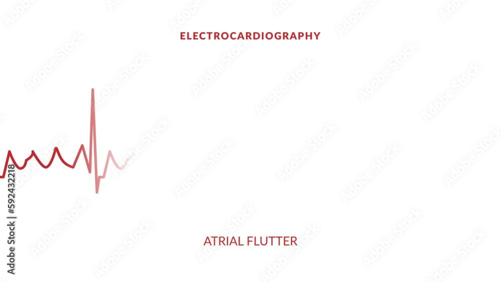 animated atrial flutter. animated ekg display Stock 비디오 | Adobe Stock