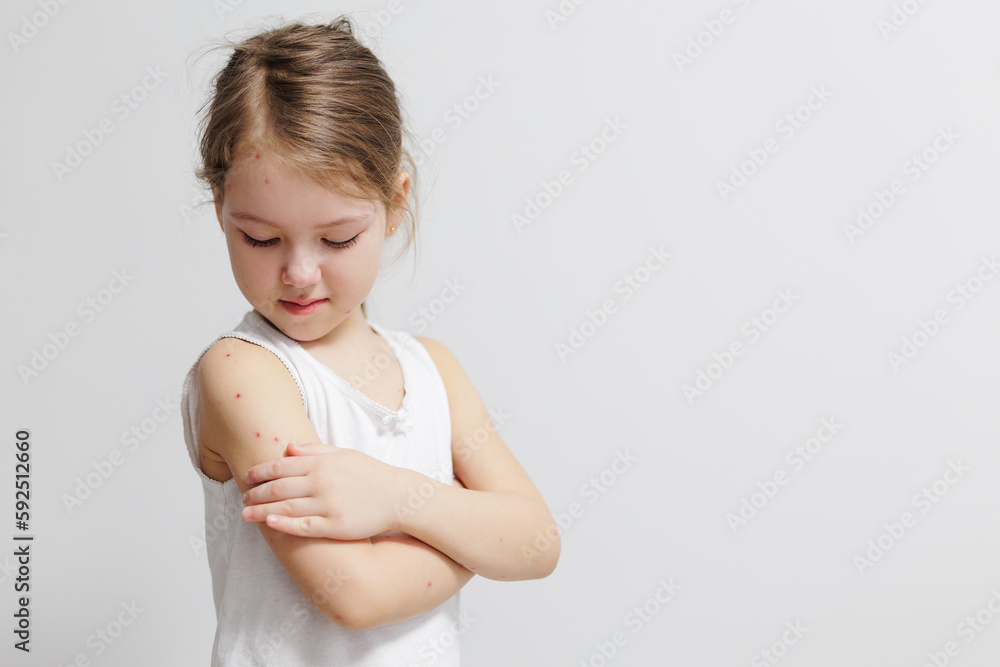 Portrait of child with pimples of chickenpox with copy space Stock ...