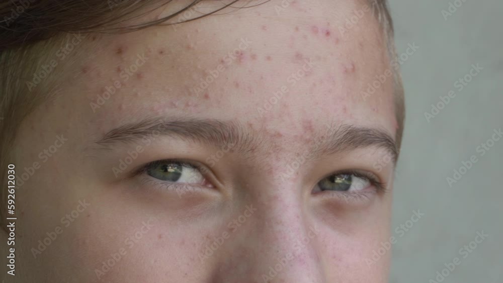 Pimples on the boy forehead,a teenager with acne on his face, a rash on ...