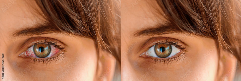 Red eye before and after treatment. Tired eyes and contact lenses ...